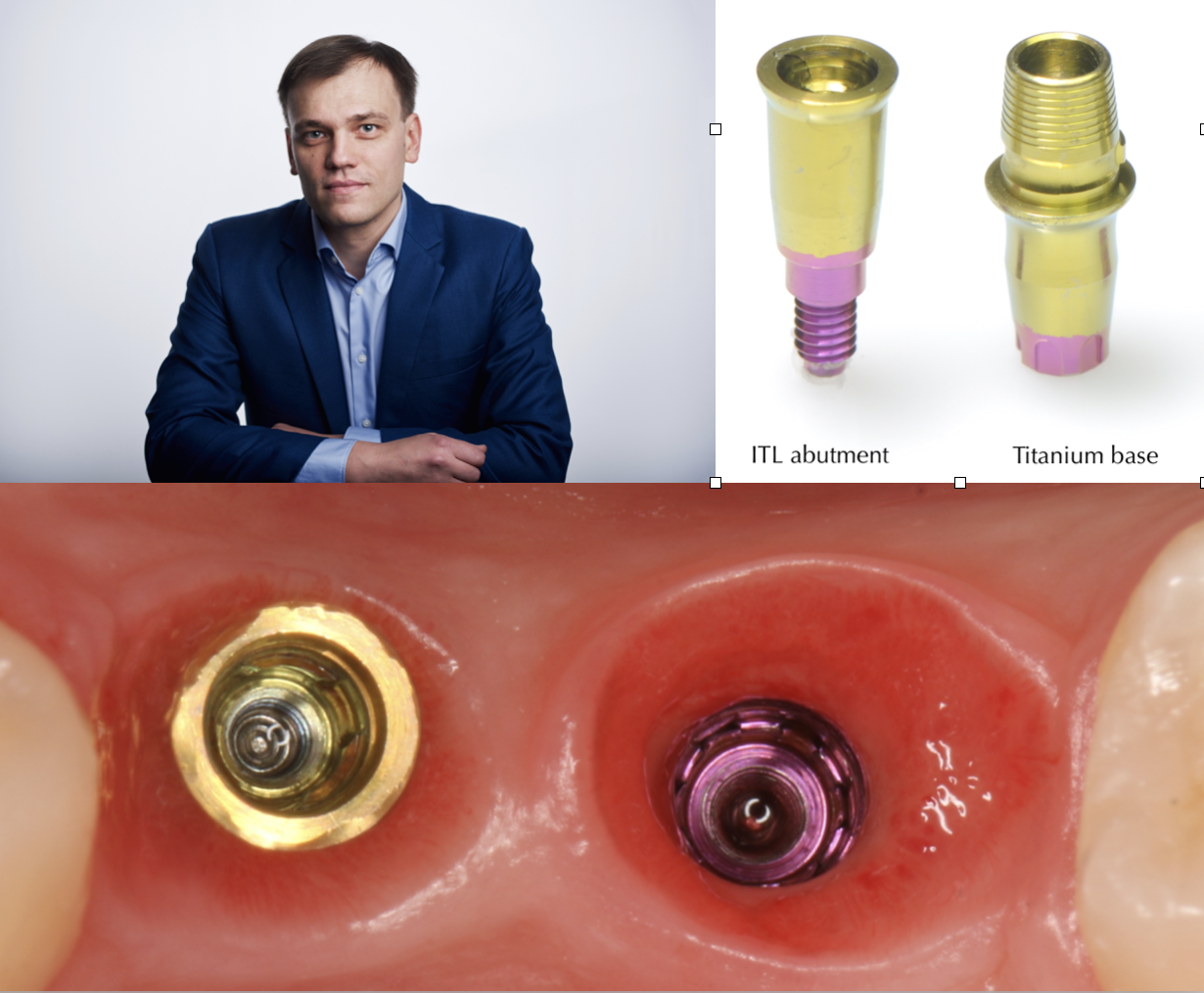 Crestal bone loss: what is it and how to avoid it? Zero Bone Loss Concepts