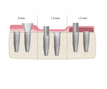 Crestal bone loss: what is it and how to avoid it? Zero Bone Loss Concepts